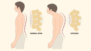 What Causes Elderly to Be Bent Over? 7 Causes of Back Bending - Human ...